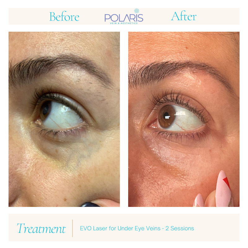 Before & After Archive - Polaris Vein & Aesthetics